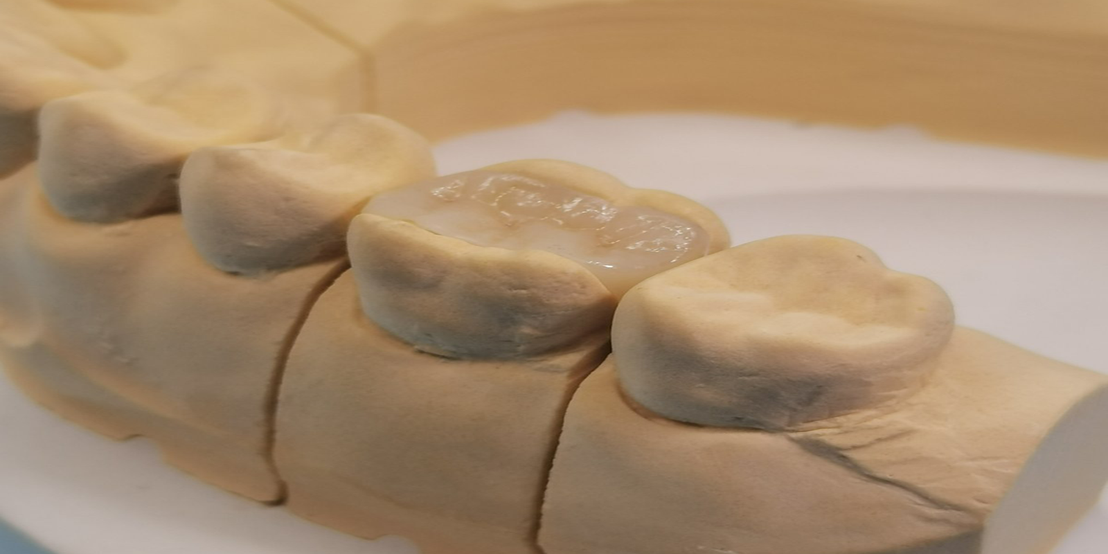 e.max Veneer - Shiken Manila Corporation