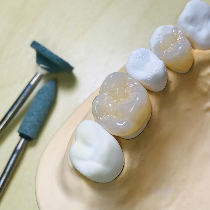 Full Zirconia-Onlay - Shiken Manila