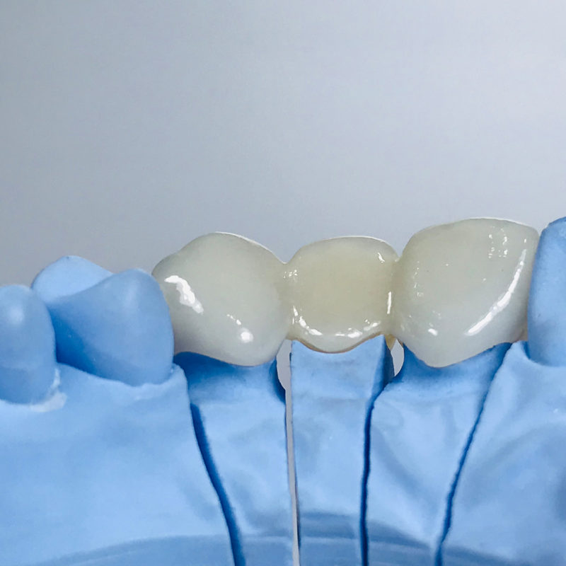 Porcelain Fused to Zirconia - Shiken Manila