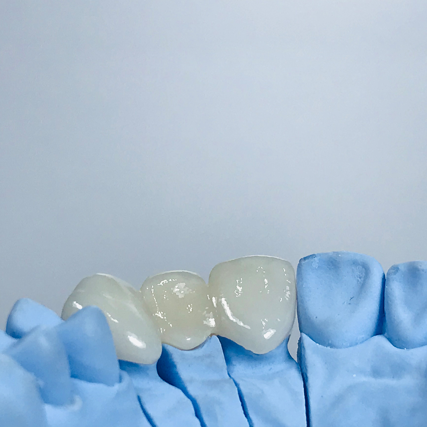 Porcelain Fused to Zirconia - Shiken Manila